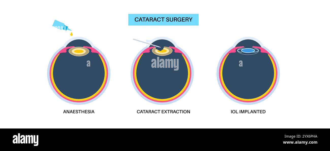 Cataract surgery, illustration Stock Photo - Alamy
