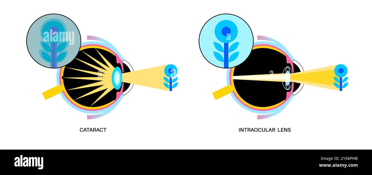Intraocular lens implantation, illustration Stock Photo - Alamy