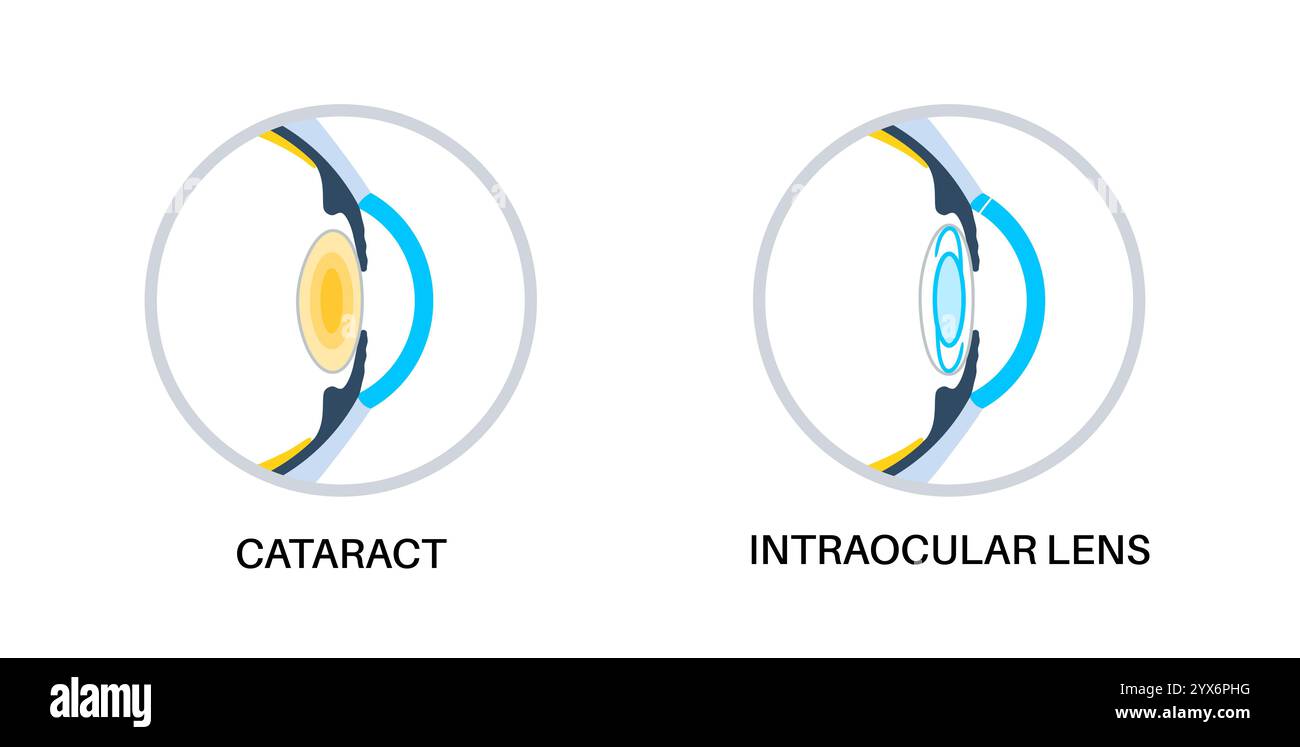 Intraocular lens implantation, illustration Stock Photo - Alamy