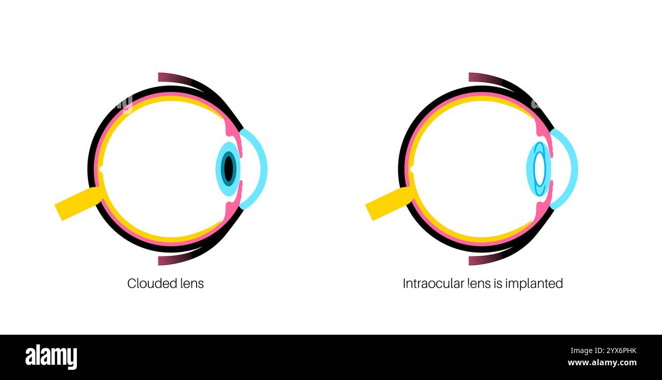 Intraocular lens implantation, illustration Stock Photo - Alamy