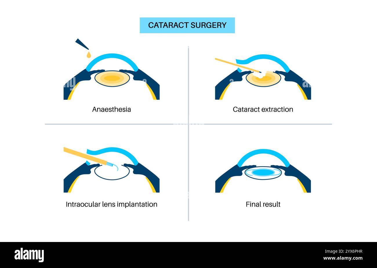 Cataract Cut Out Stock Images & Pictures - Alamy