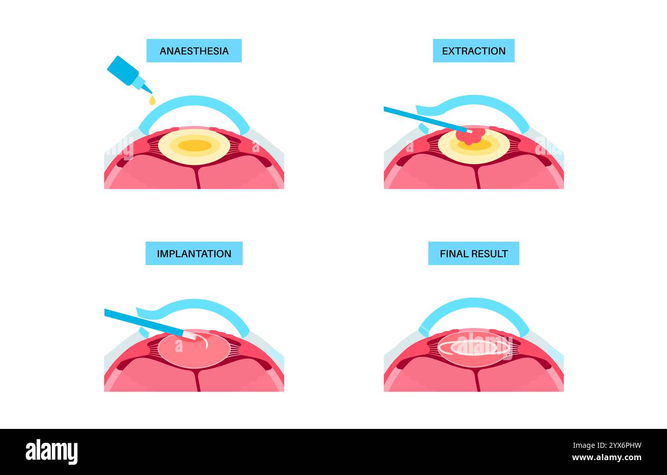 Cataract surgery, illustration Stock Photo - Alamy