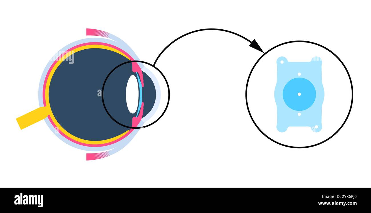 Implantable collamer lens surgery, illustration Stock Photo - Alamy