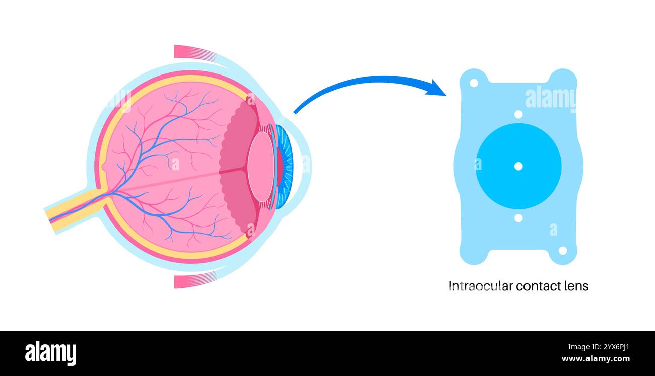 Implantable collamer lens surgery, illustration Stock Photo - Alamy