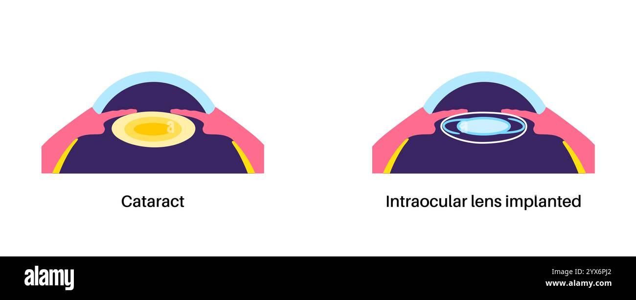 Intraocular lens implantation, illustration Stock Photo - Alamy