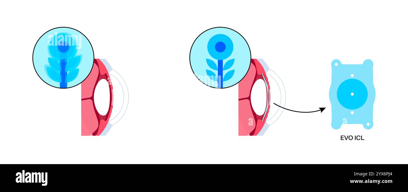 Implantable collamer lens surgery, illustration Stock Photo - Alamy