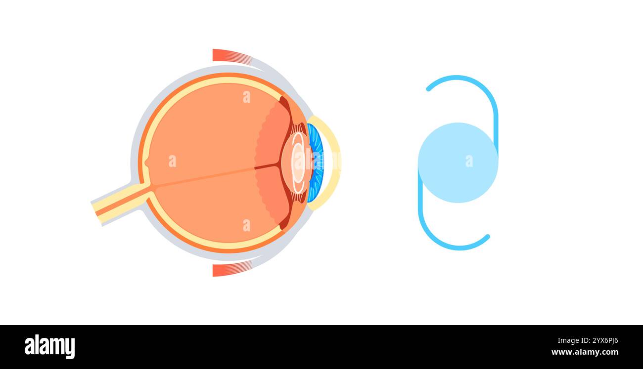 Intraocular lens implantation, illustration Stock Photo - Alamy