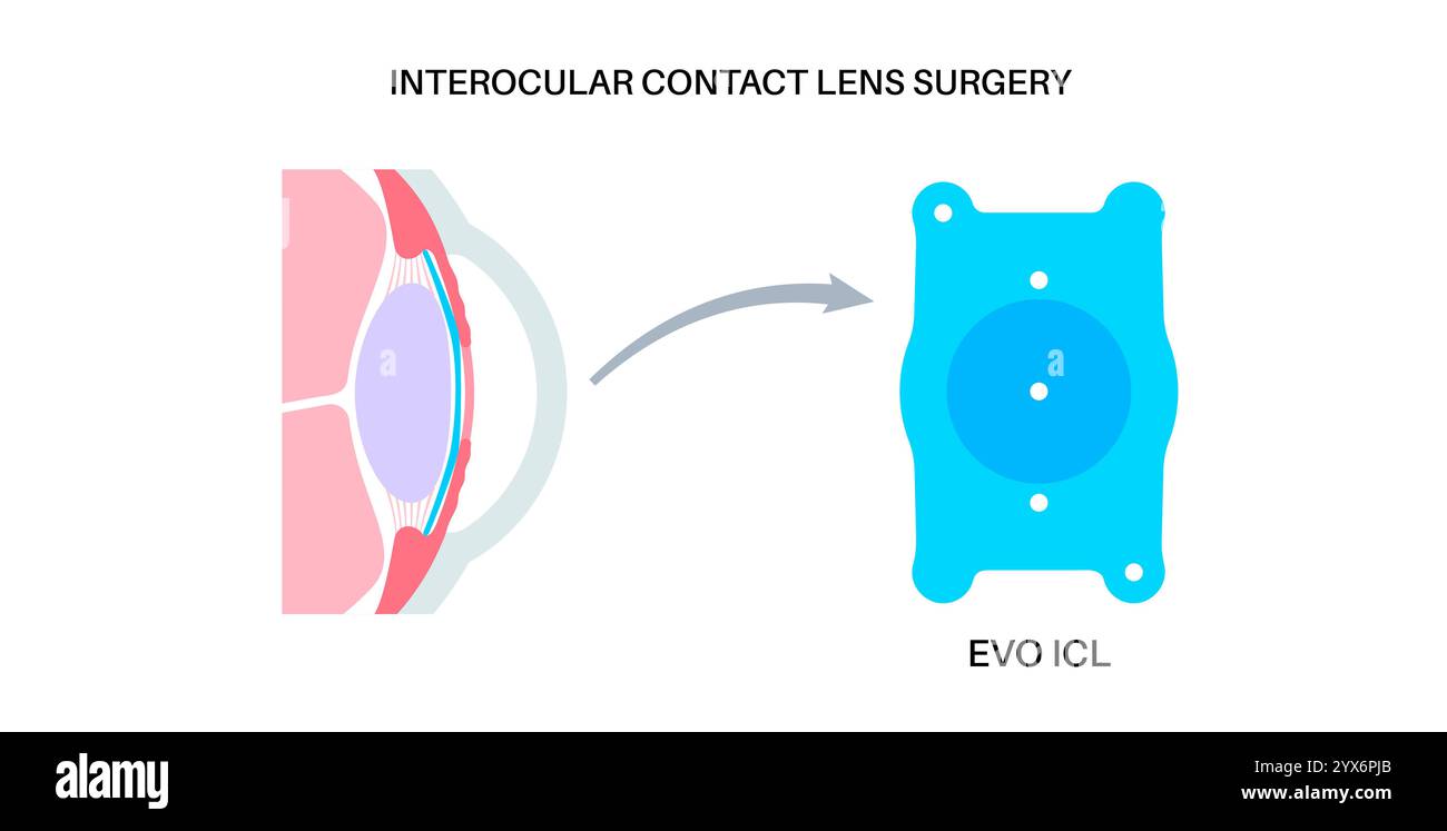 Implantable collamer lens surgery, illustration Stock Photo - Alamy
