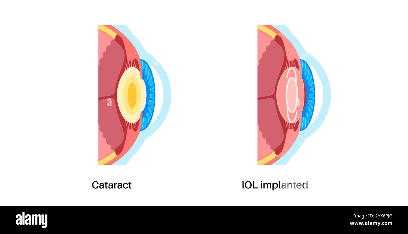 Intraocular pressure hi-res stock photography and images - Alamy