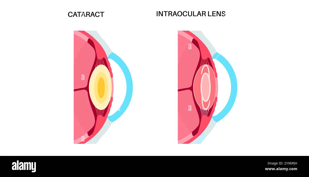 Intraocular lens implantation, illustration Stock Photo - Alamy