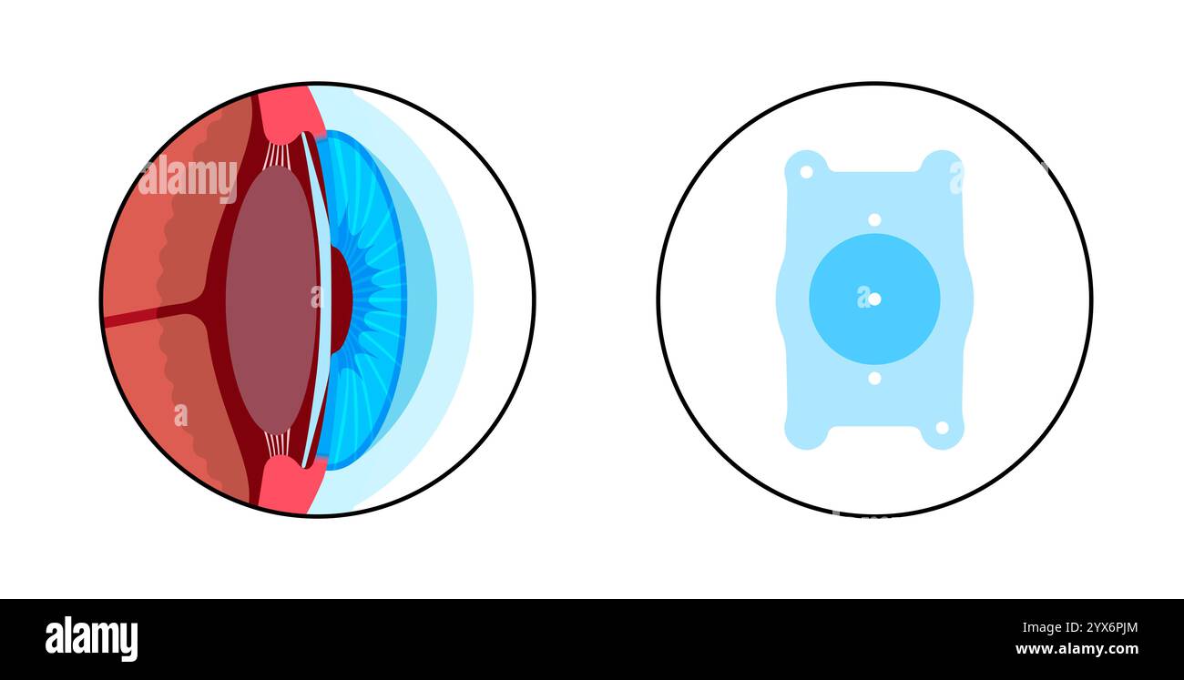 Implantable collamer lens surgery, illustration Stock Photo - Alamy