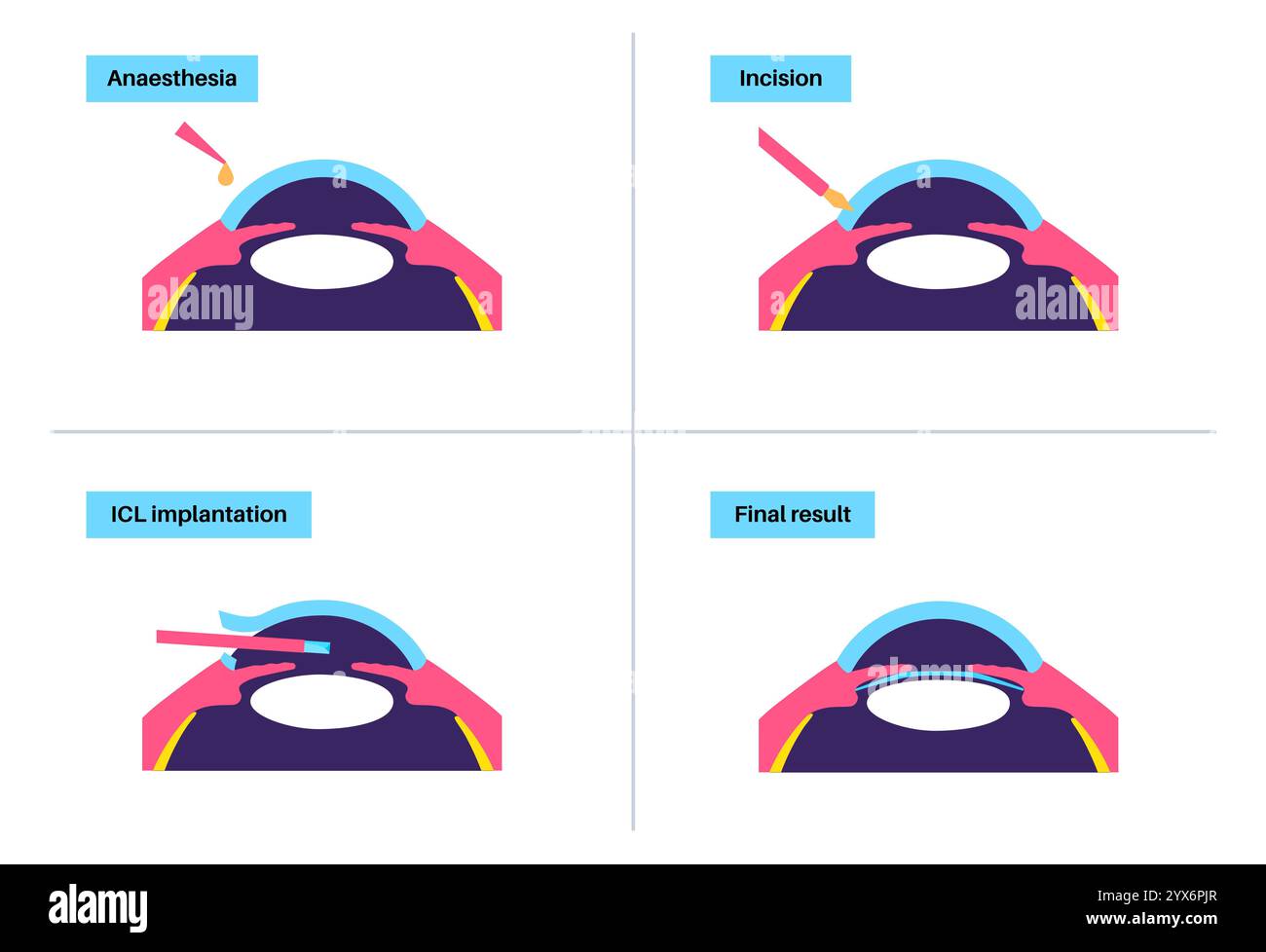 Implantable collamer lens surgery, illustration Stock Photo - Alamy