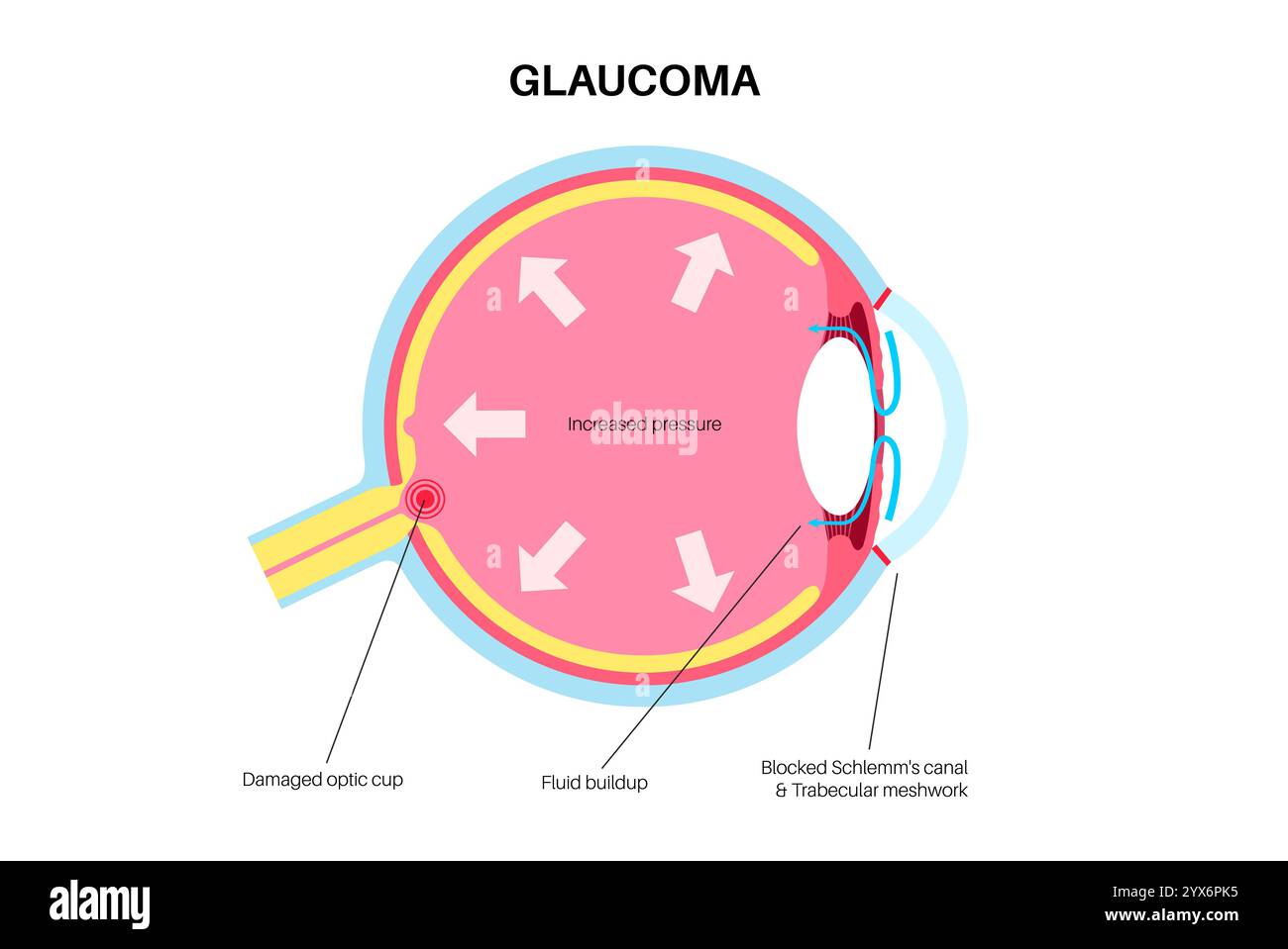 Glaucoma diagram Cut Out Stock Images & Pictures - Alamy
