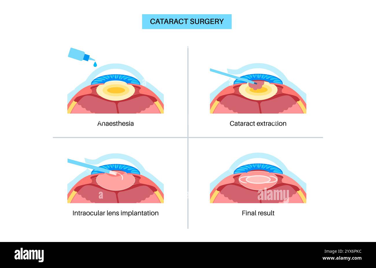 Cataract surgery, illustration Stock Photo - Alamy