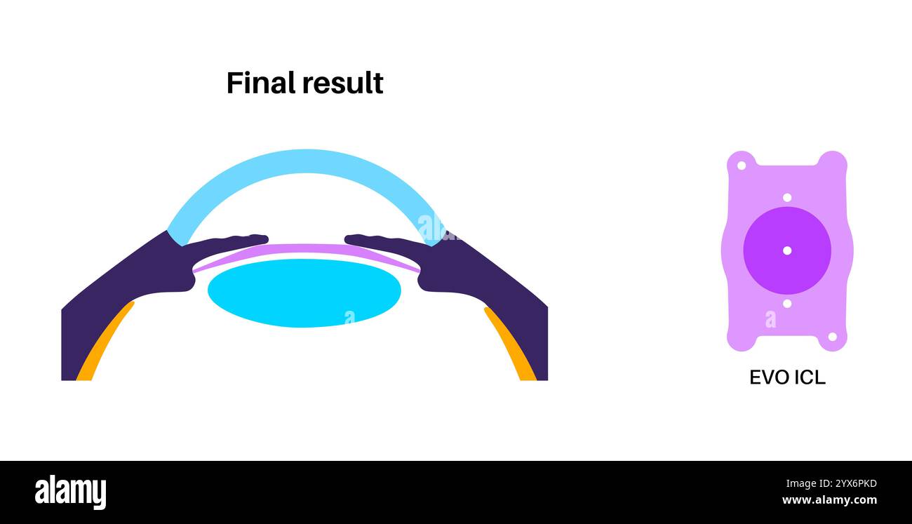 Implantable collamer lens surgery, illustration Stock Photo - Alamy