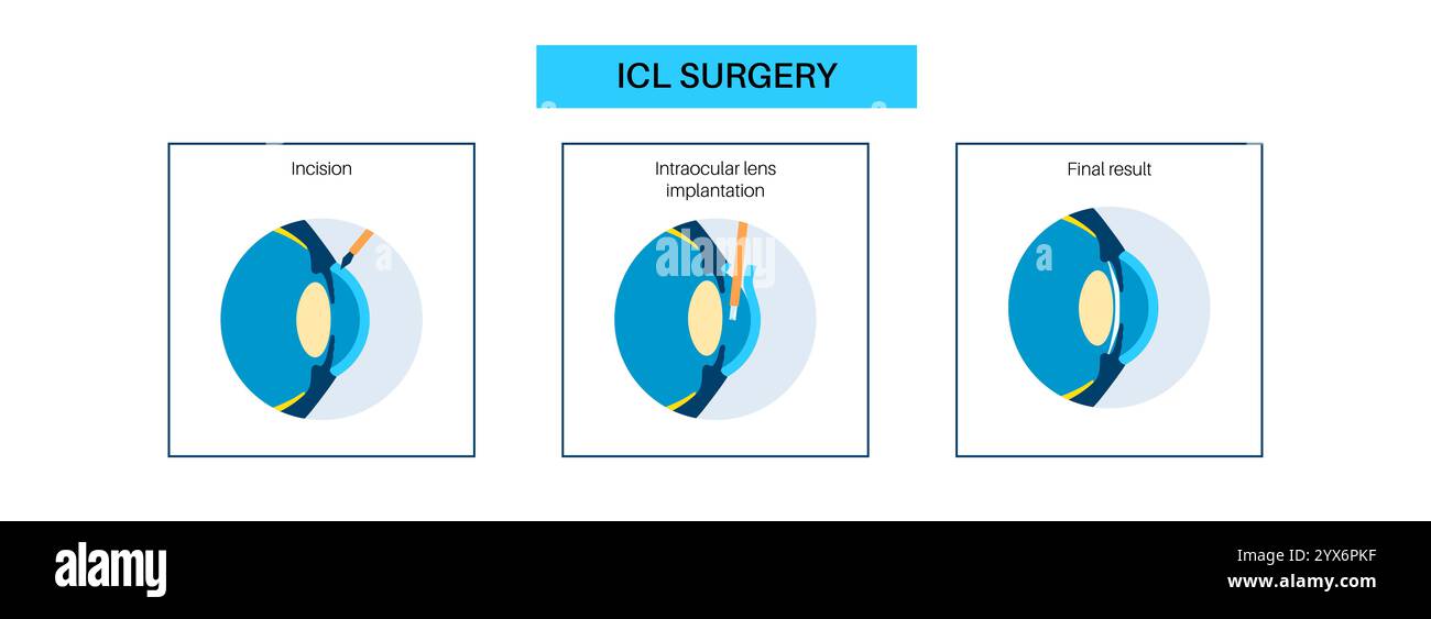 Implantable collamer lens surgery, illustration Stock Photo - Alamy