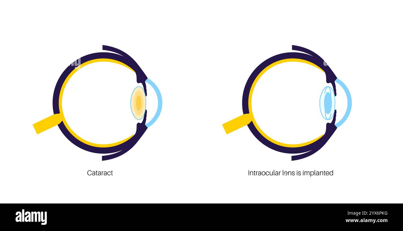 Intraocular lens implantation, illustration Stock Photo - Alamy