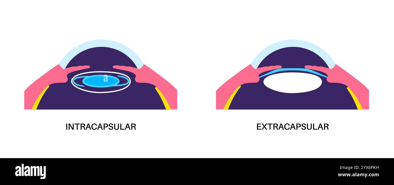 Implantable collamer lens surgery, illustration Stock Photo - Alamy