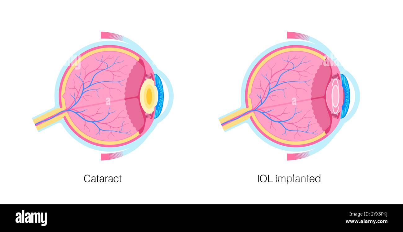 Intraocular lens implantation, illustration Stock Photo - Alamy