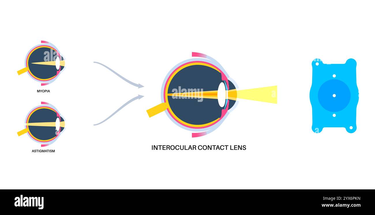 Implantable collamer lens surgery, illustration Stock Photo - Alamy