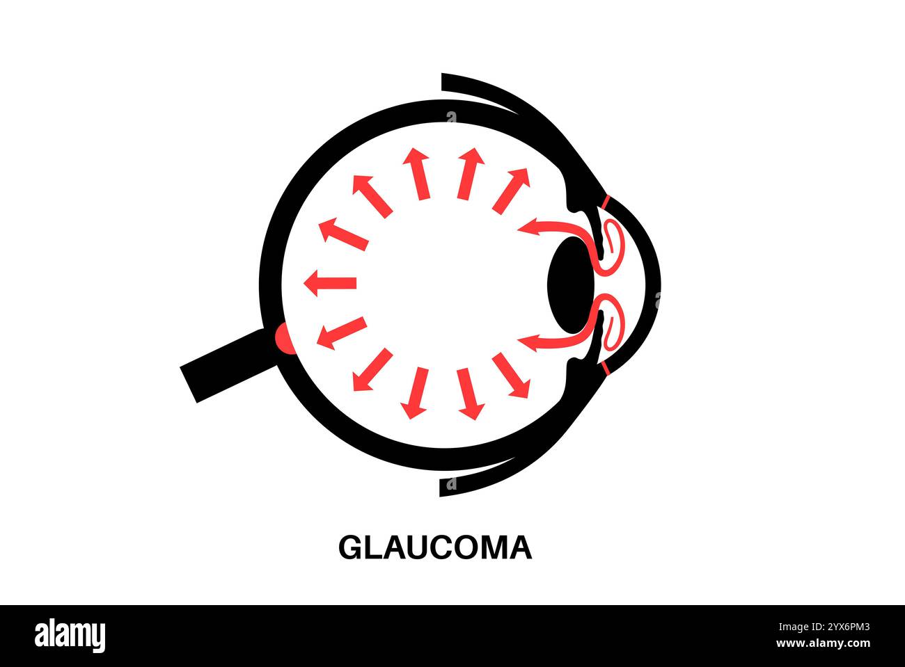 Glaucoma diagram Cut Out Stock Images & Pictures - Alamy
