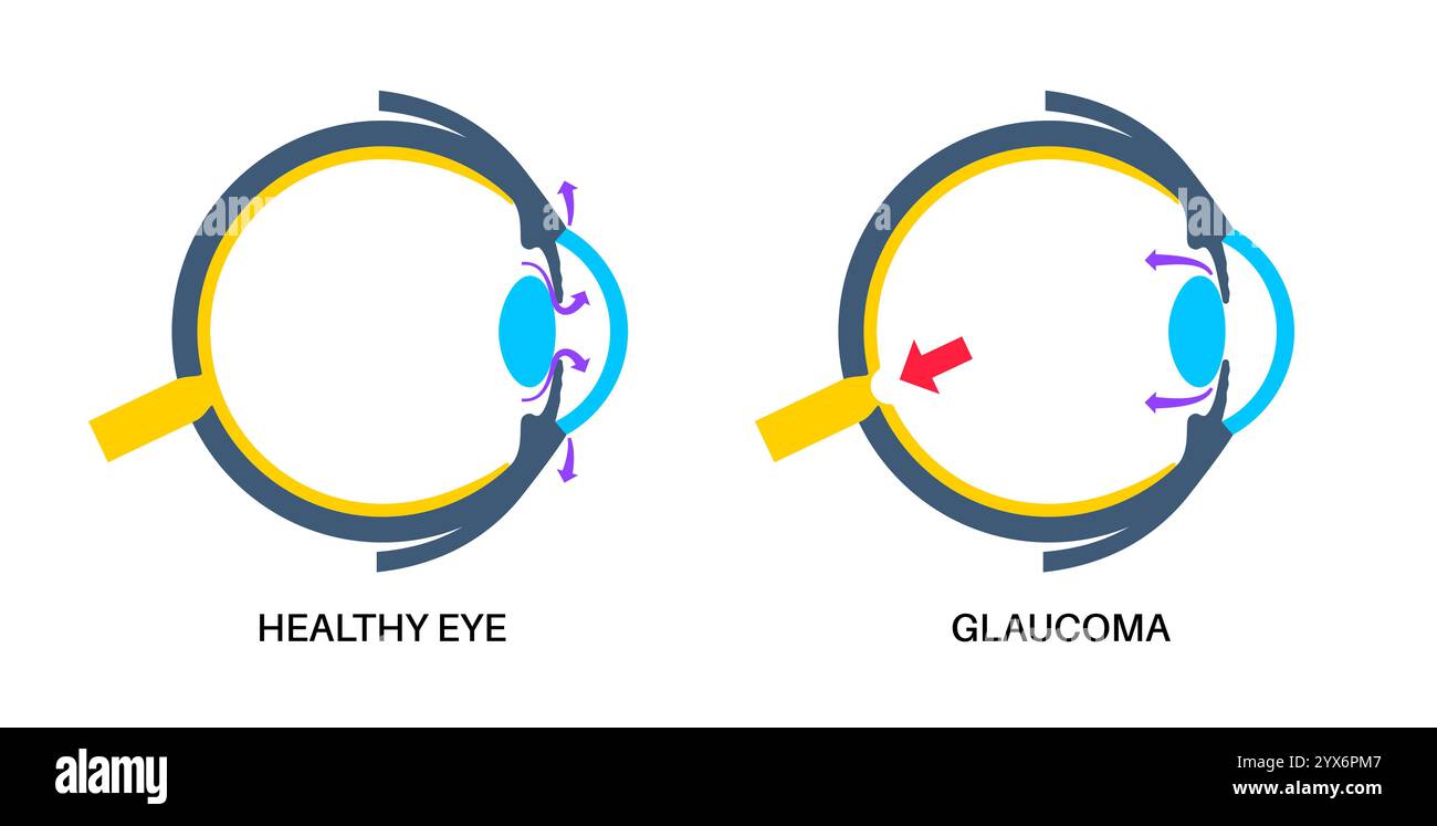 Glaucoma diagram Cut Out Stock Images & Pictures - Alamy