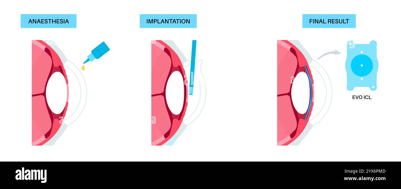 Implantable collamer lens surgery, illustration Stock Photo - Alamy