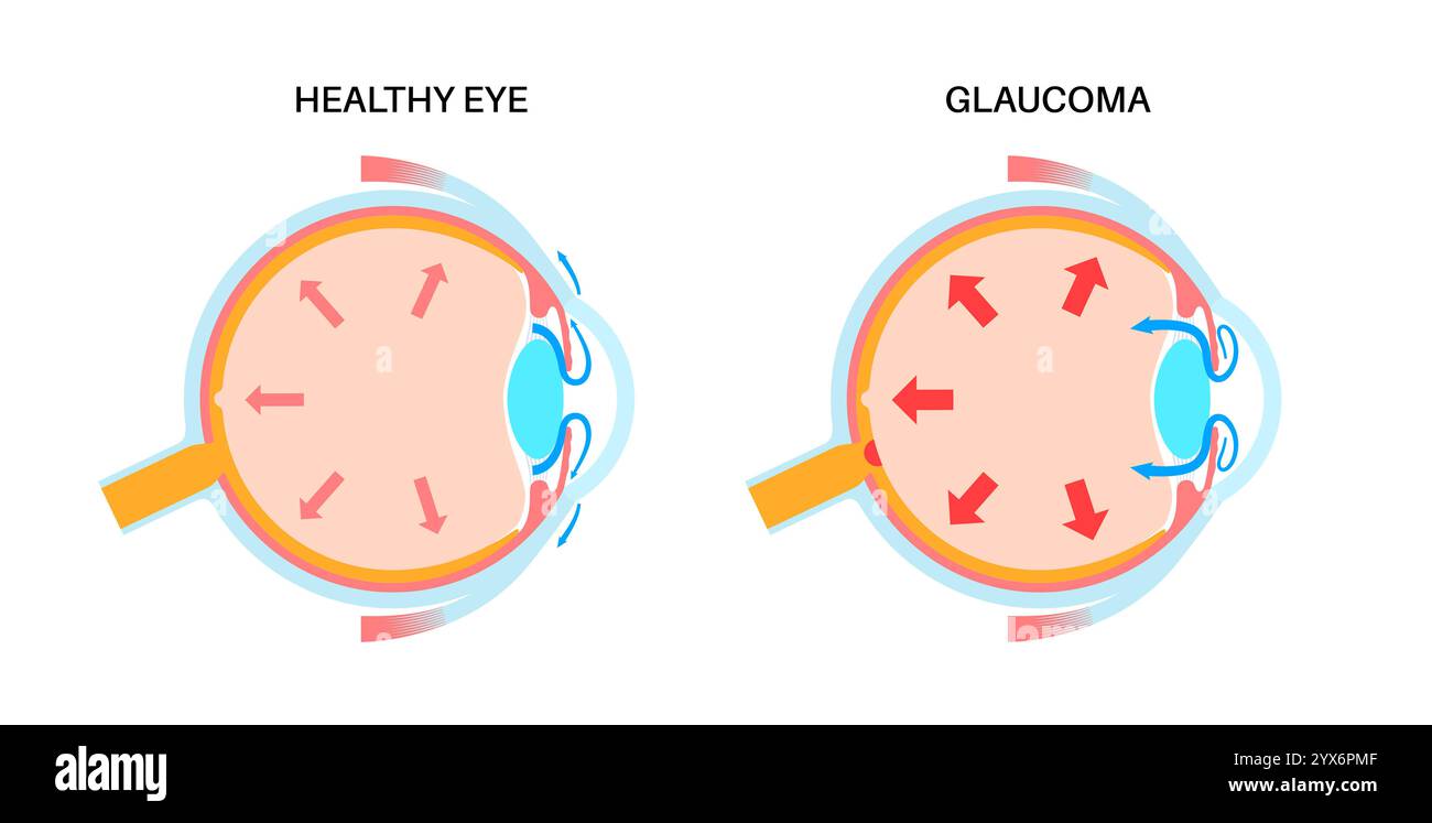 Glaucoma diagram Cut Out Stock Images & Pictures - Alamy