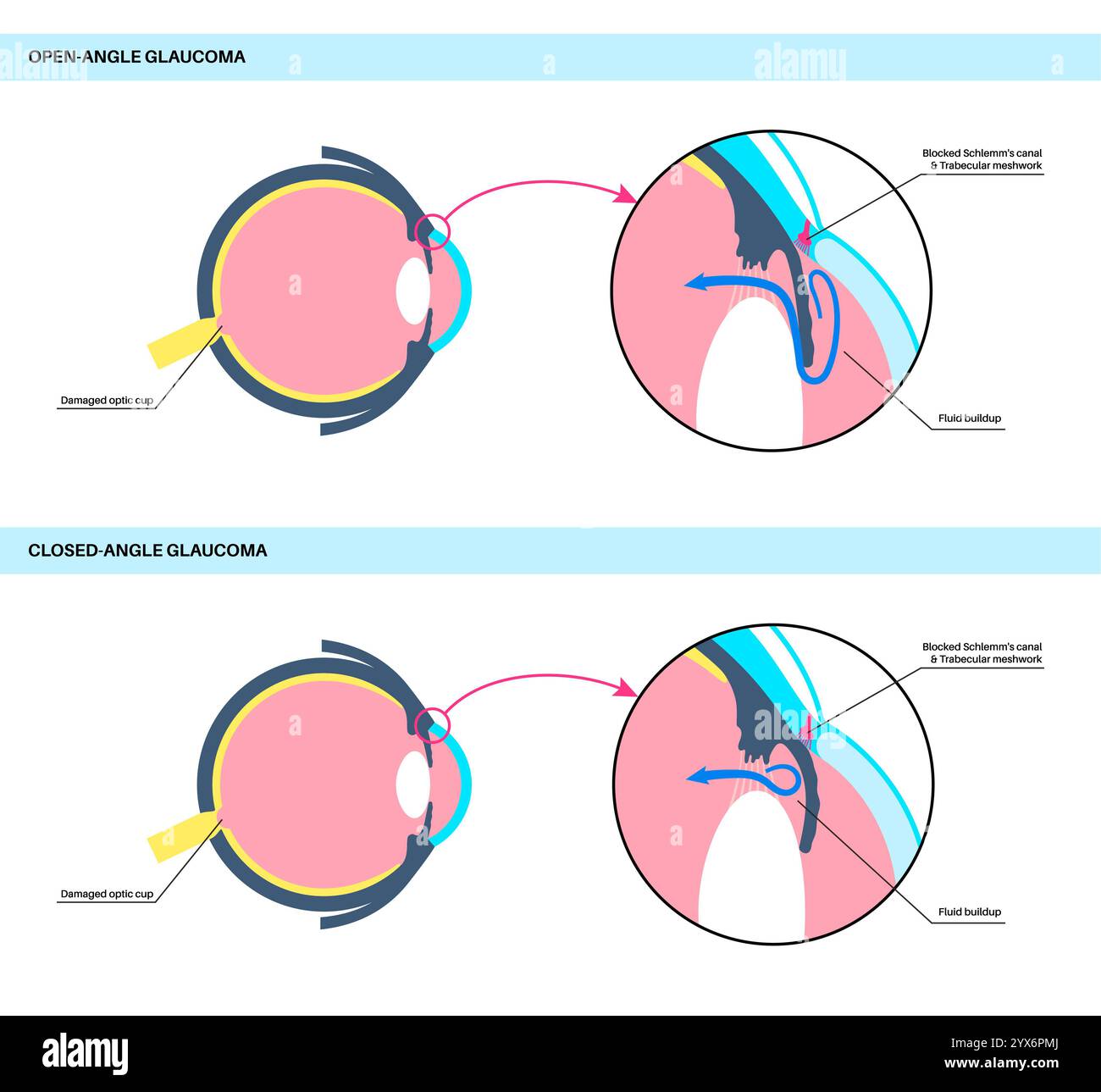 Glaucoma eye disease, illustration Stock Photo - Alamy