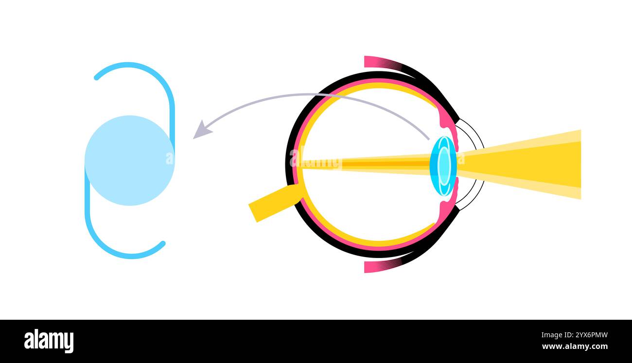 Intraocular lens implantation, illustration Stock Photo - Alamy