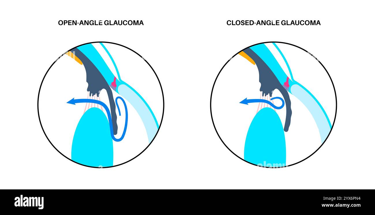 Glaucoma vision Cut Out Stock Images & Pictures - Alamy
