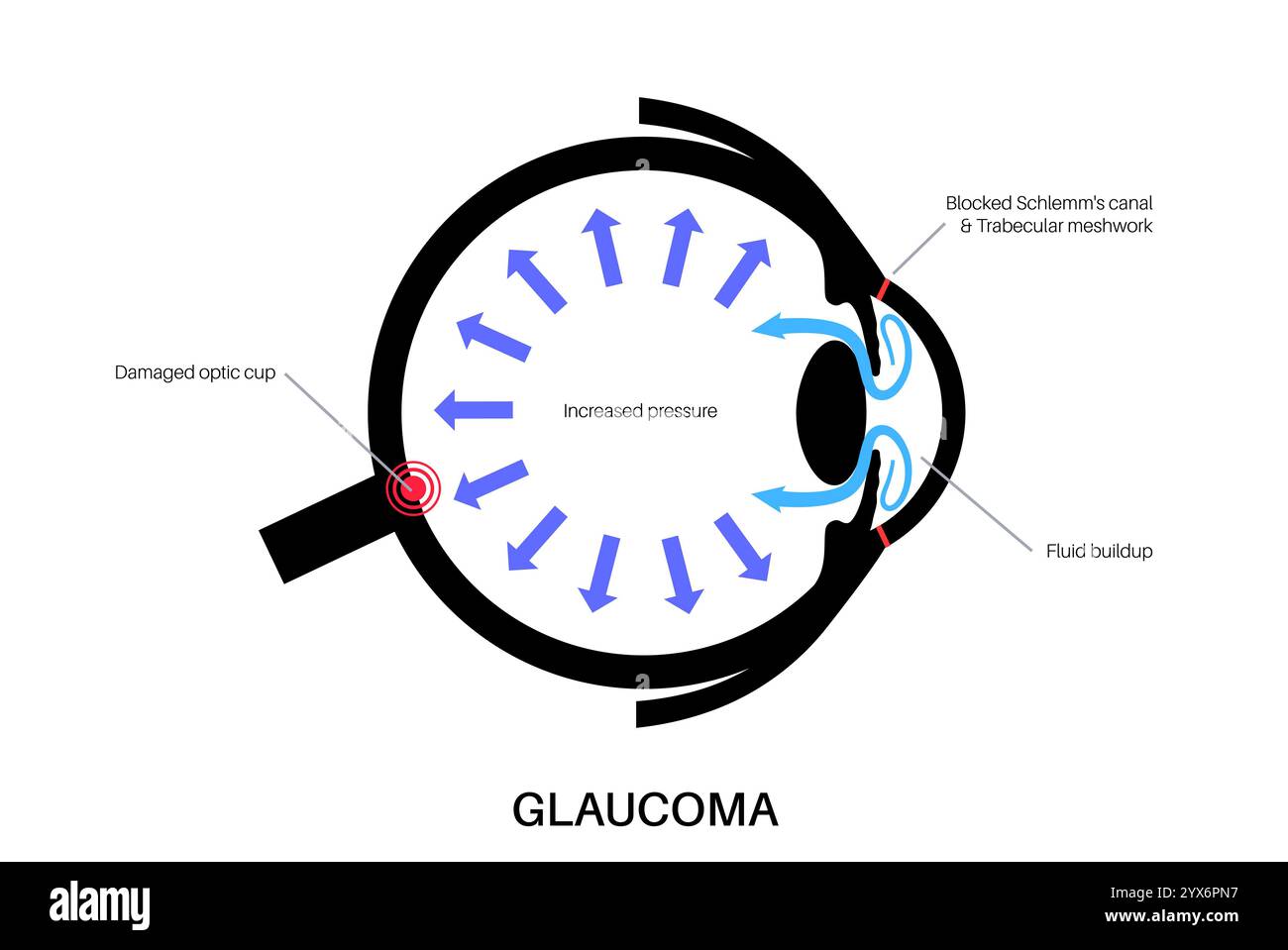 Glaucoma diagram Cut Out Stock Images & Pictures - Alamy