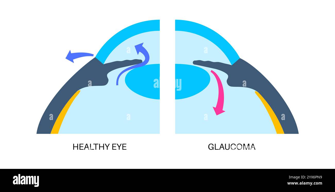 Glaucoma eye disease, illustration Stock Photo - Alamy