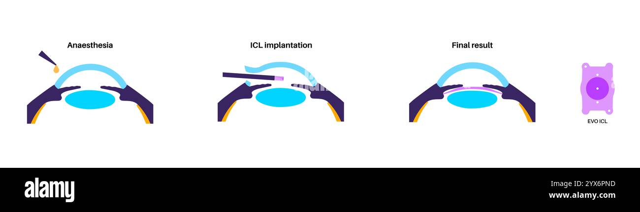 Implantable collamer lens surgery, illustration Stock Photo - Alamy