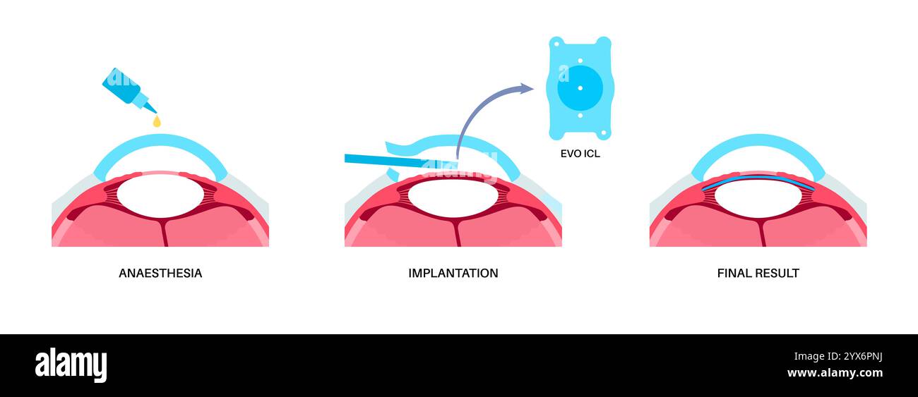 Implantable collamer lens surgery, illustration Stock Photo - Alamy