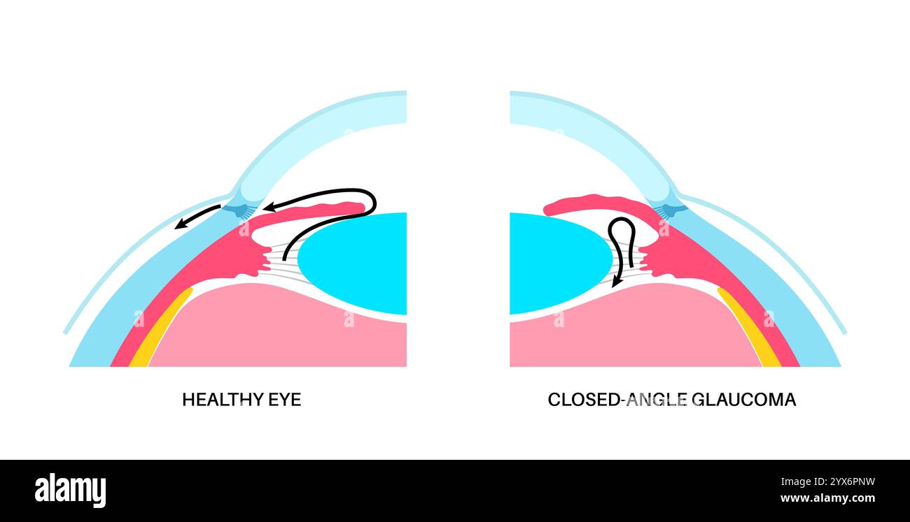 Glaucoma eye disease, illustration Stock Photo - Alamy
