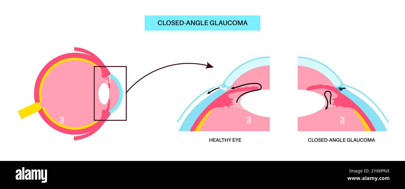Glaucoma eye disease, illustration Stock Photo - Alamy