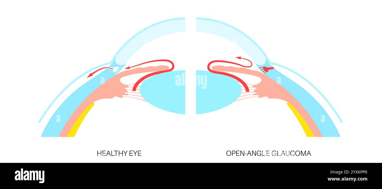 Glaucoma eye disease, illustration Stock Photo - Alamy