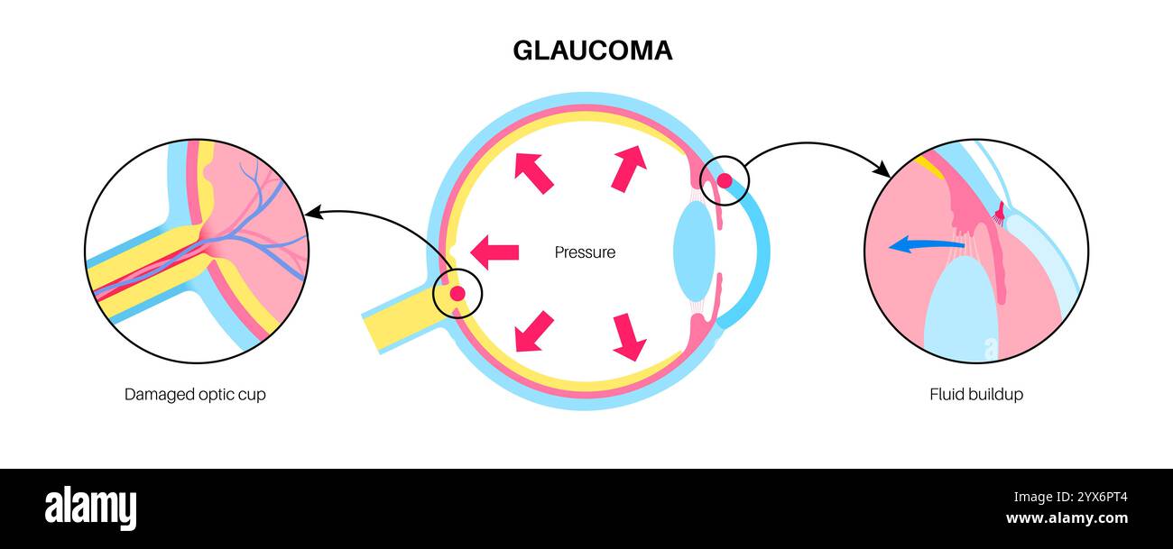 Glaucoma eye disease, illustration Stock Photo - Alamy