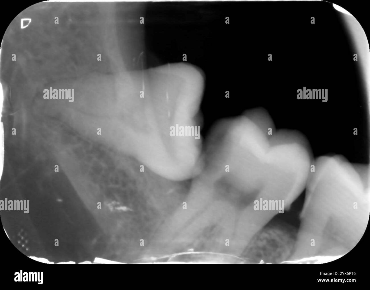 Periapical X-ray of an impacted right lower wisdom tooth. The wisdom ...