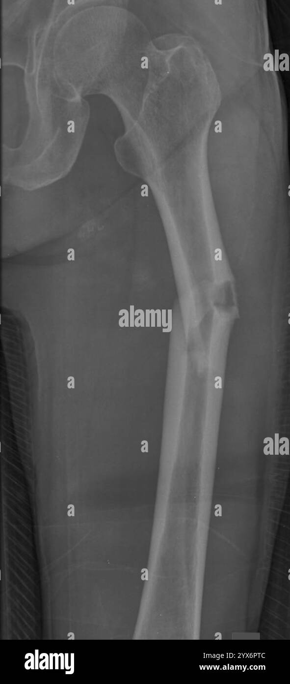 X-ray of a fractured femur (thigh bone). There is also an aneurysmal ...
