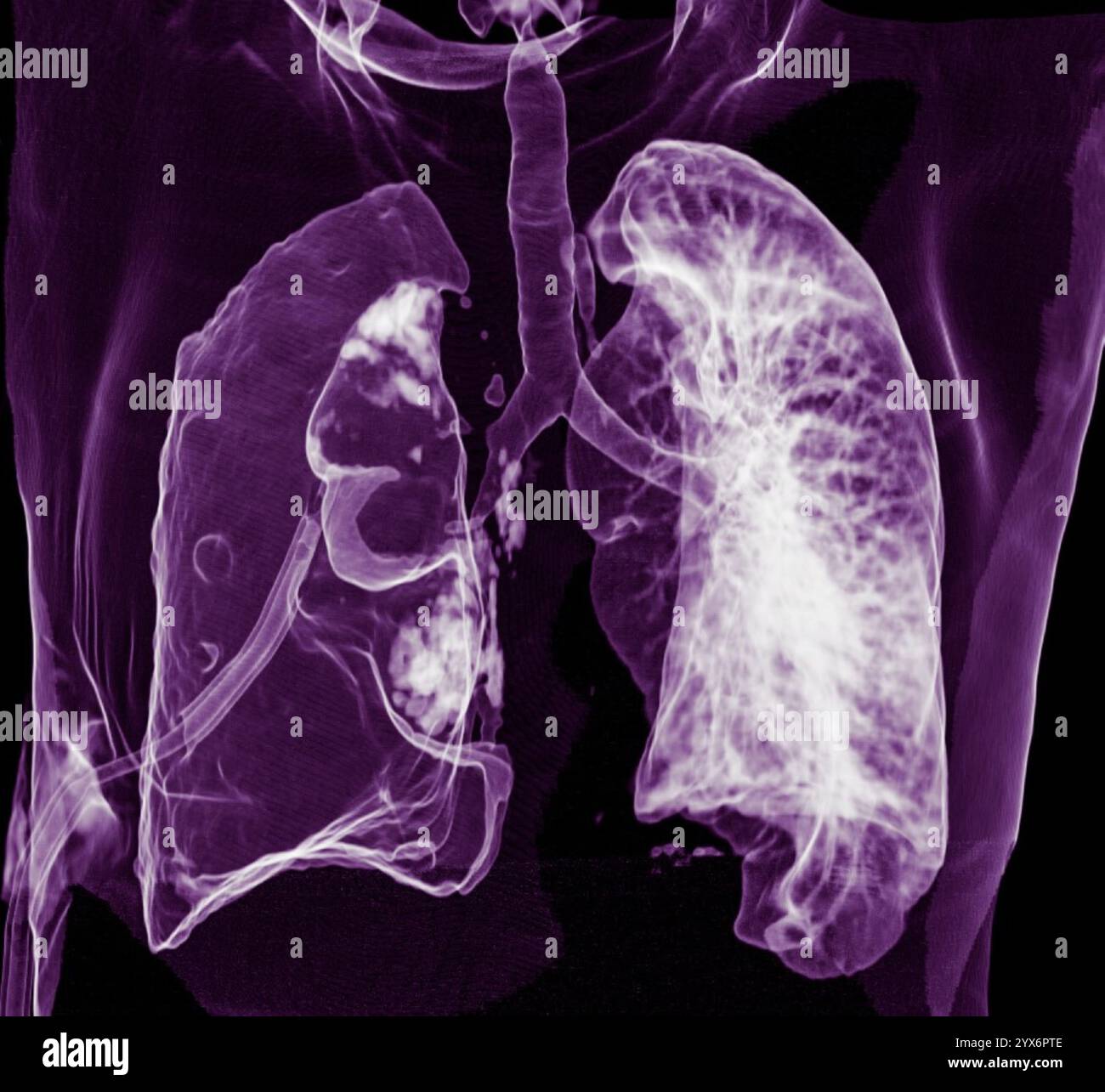 Coloured 3D computed tomography (CT) scan of the chest of a 60 year old ...