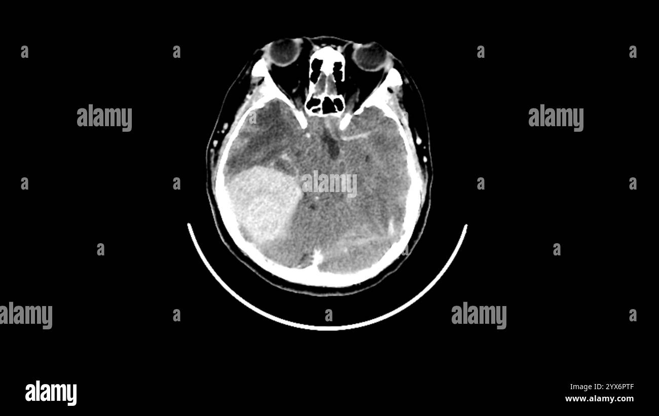 Axial computed tomography (CT) scan of a patient's head showing a ...