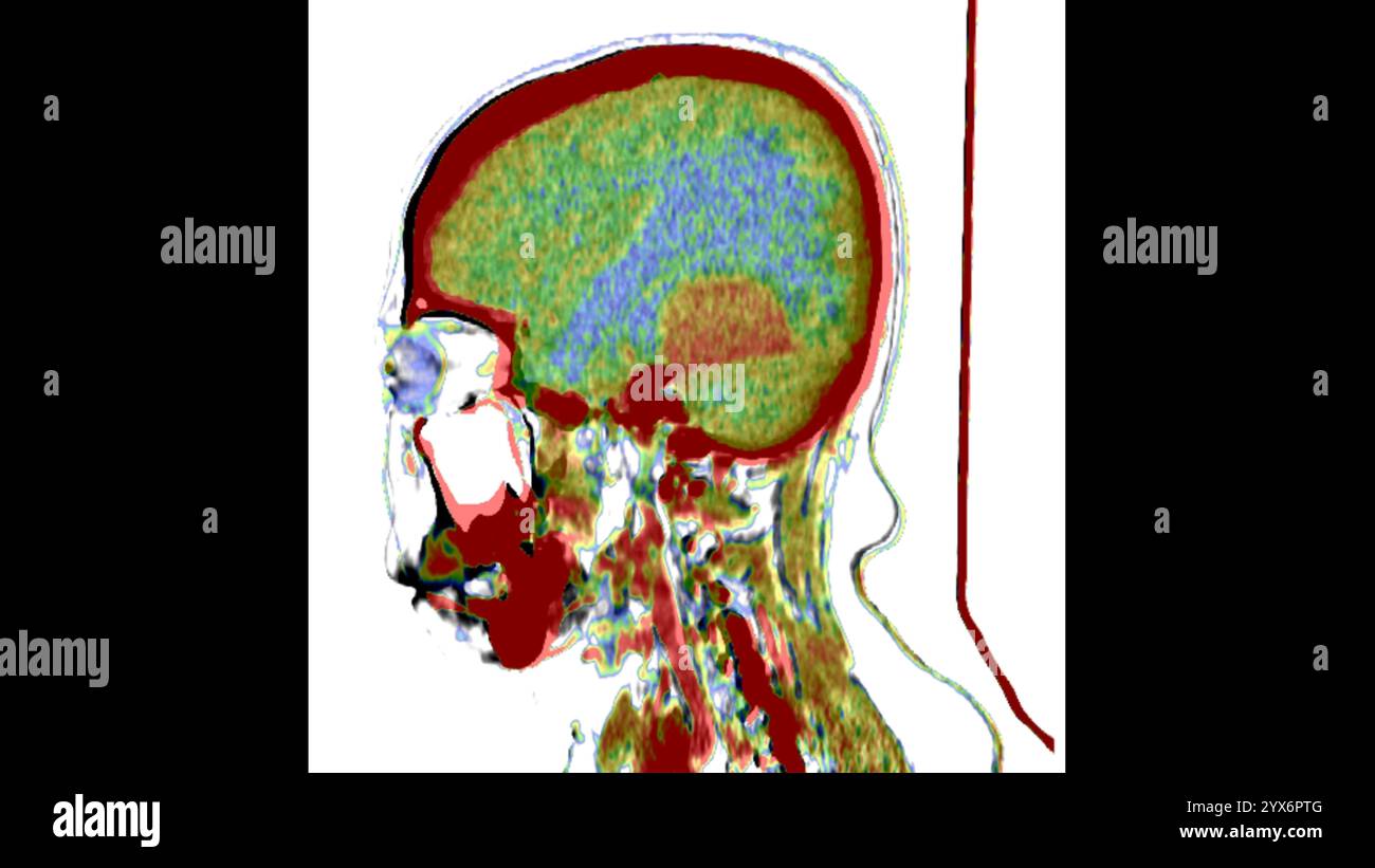 Sagittal computed tomography (CT) scan of a patient's head showing a meningioma (orange, centre ...