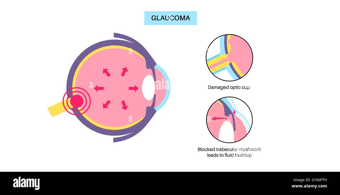 Glaucoma eye disease, illustration Stock Photo - Alamy