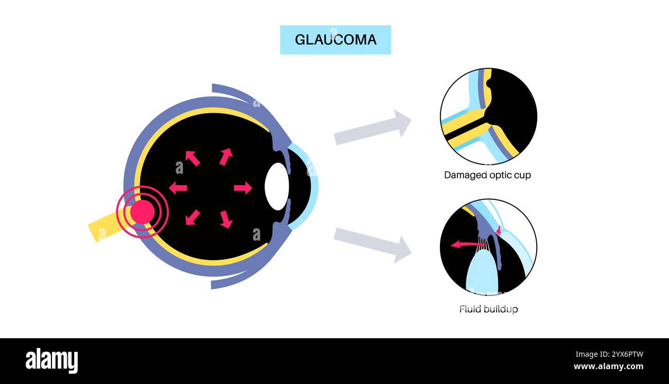 Glaucoma eye disease, illustration Stock Photo - Alamy