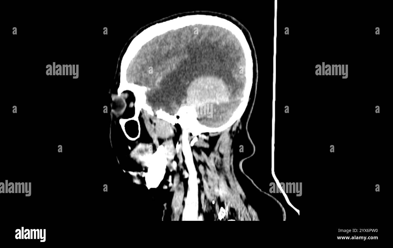 Sagittal computed tomography (CT) scan of a patient's head showing a ...