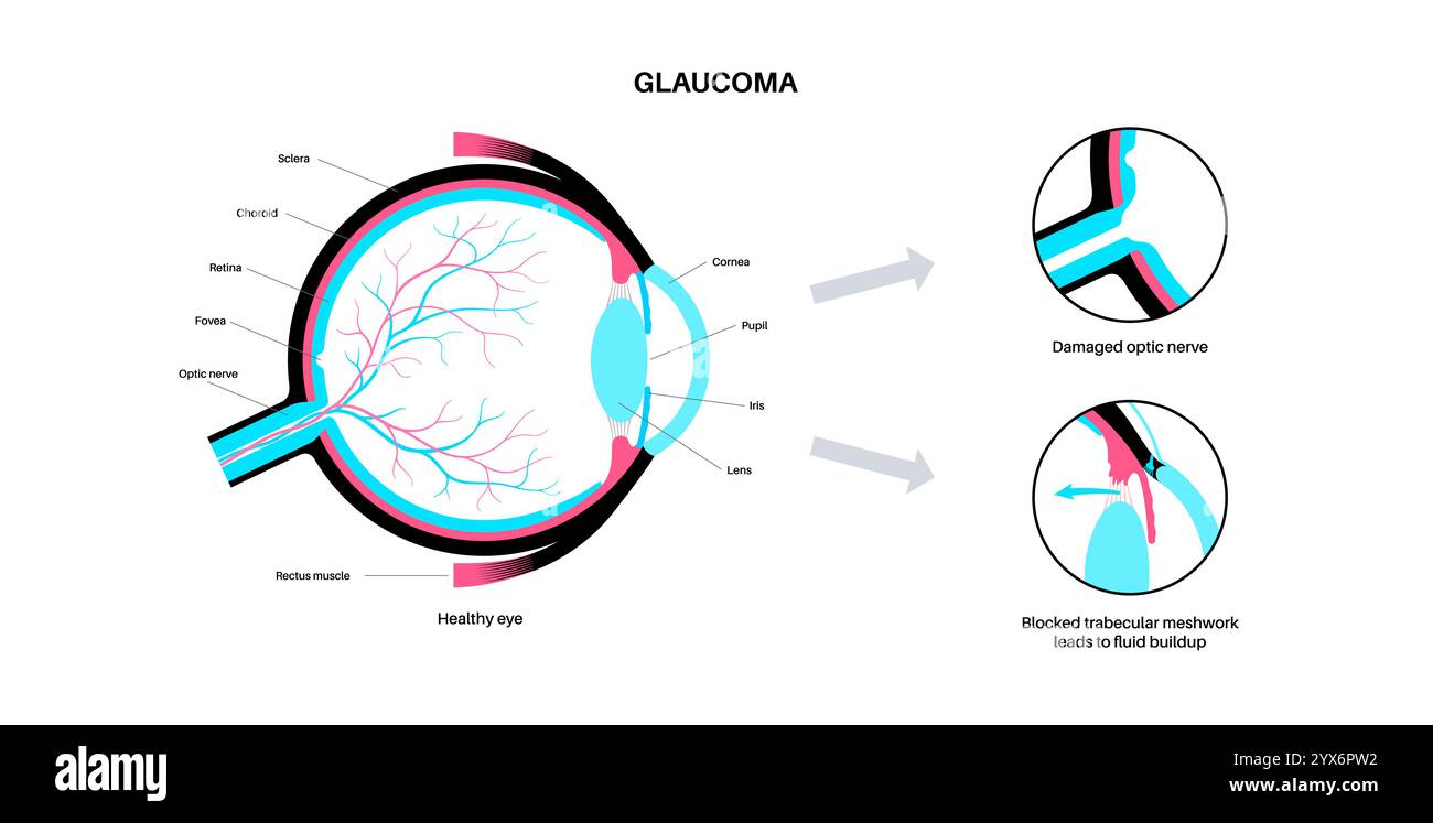 Glaucoma eye disease, illustration Stock Photo - Alamy