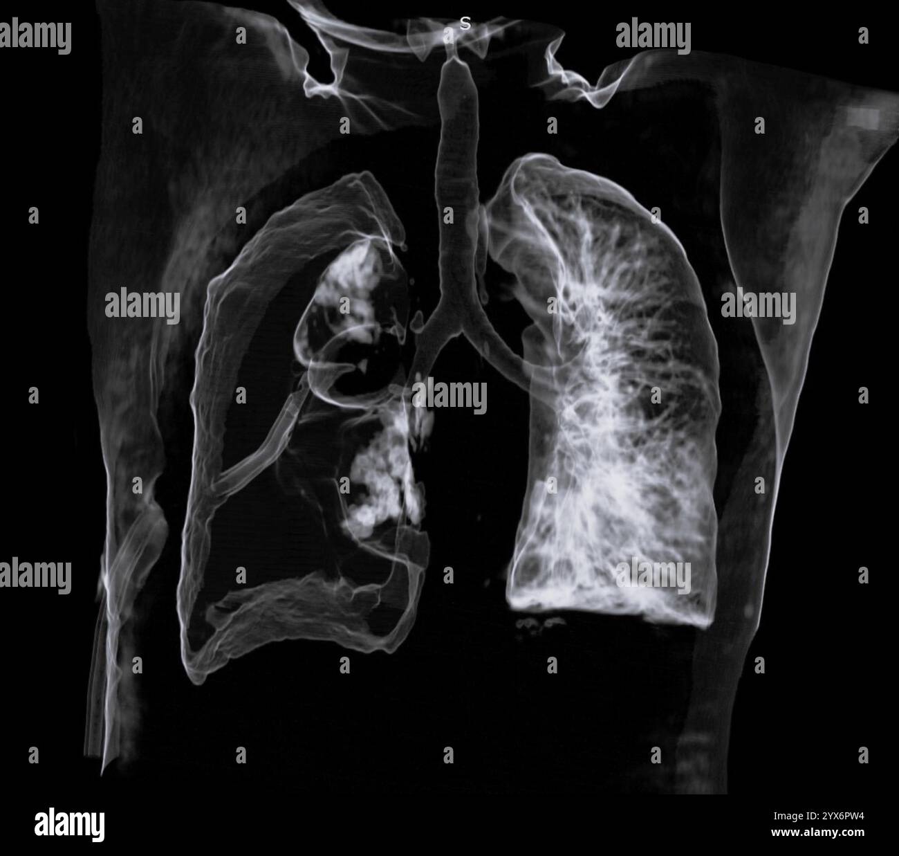 3D computed tomography (CT) scan of the chest of a 60 year old male ...