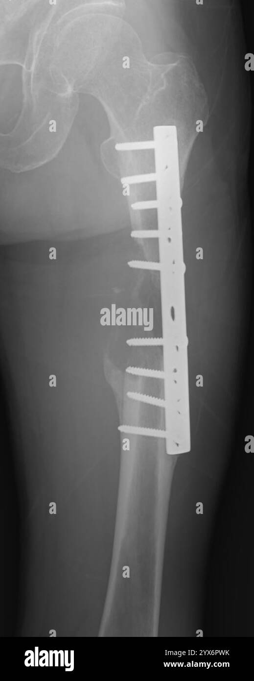 X-ray of a fractured femur (thigh bone) that has been internally fixed ...